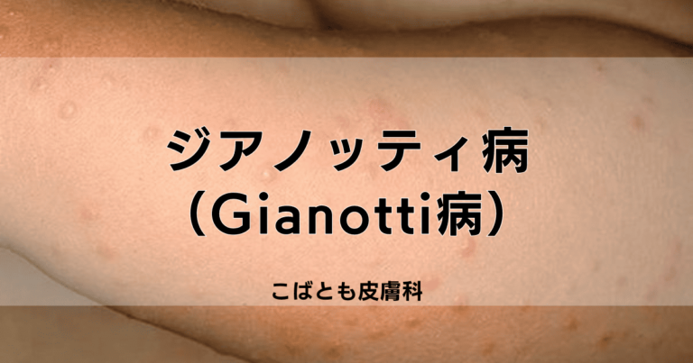 ジアノッティ病（Gianotti病）｜こばとも皮膚科｜栄駅（名古屋市栄区）徒歩2分