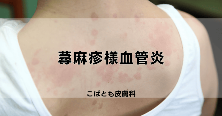 蕁麻疹様血管炎｜こばとも皮膚科｜栄駅（名古屋市栄区）徒歩2分